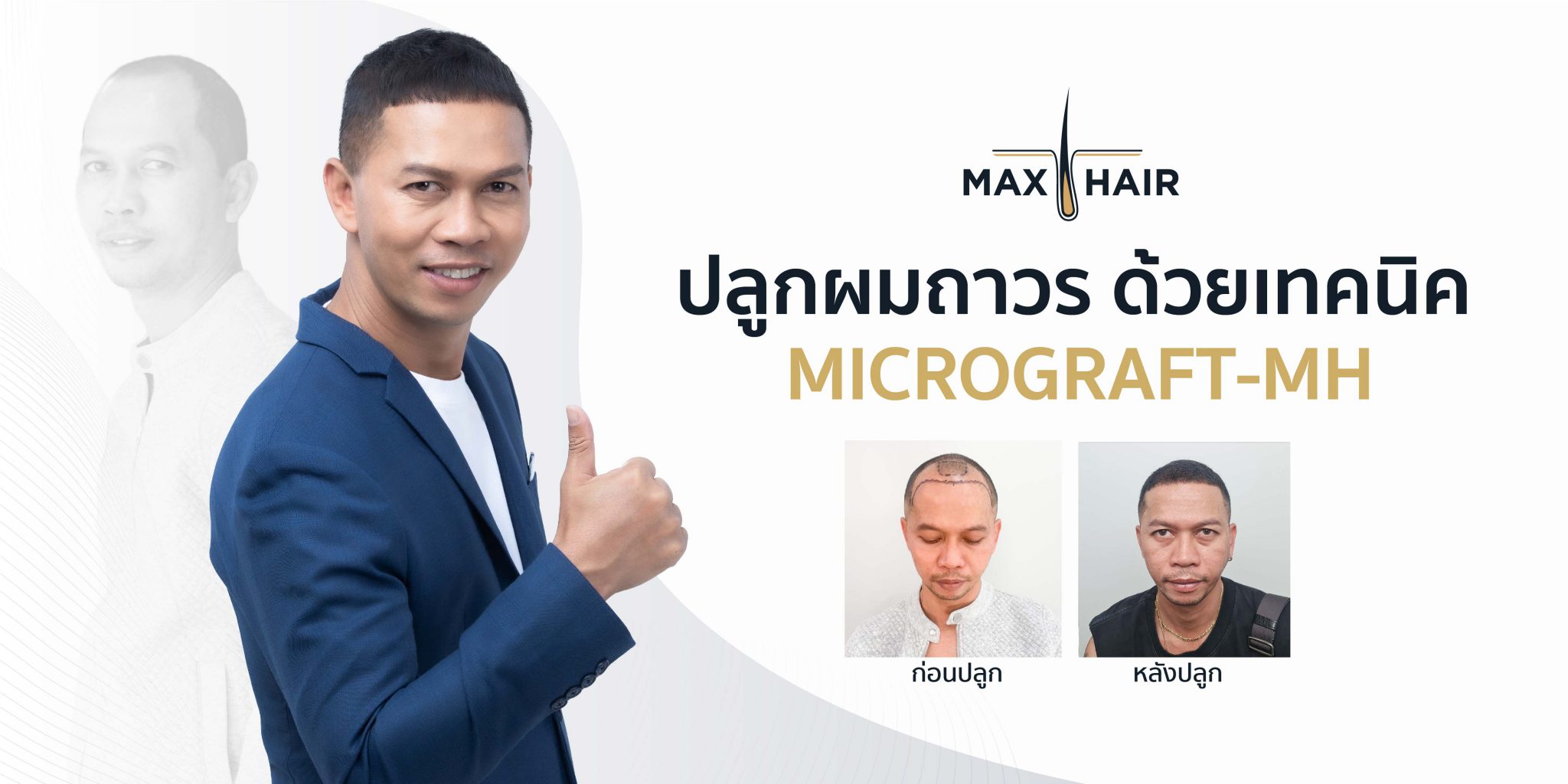 คลินิกปลูกผม เทคนิค Micrograft (MCG) | Max Hair Thailand