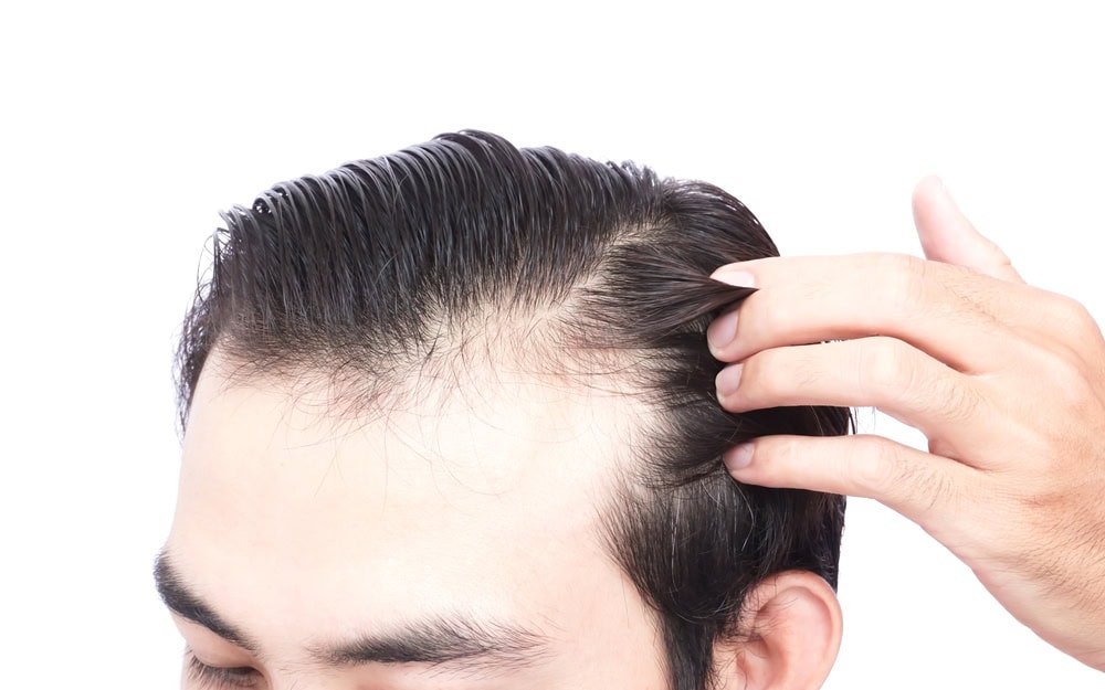 Why Is My Hairline Receding? Answers To Common Questions